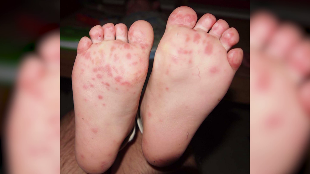 ¿Qué es el virus coxsackie? - Canal 12 de El Salvador